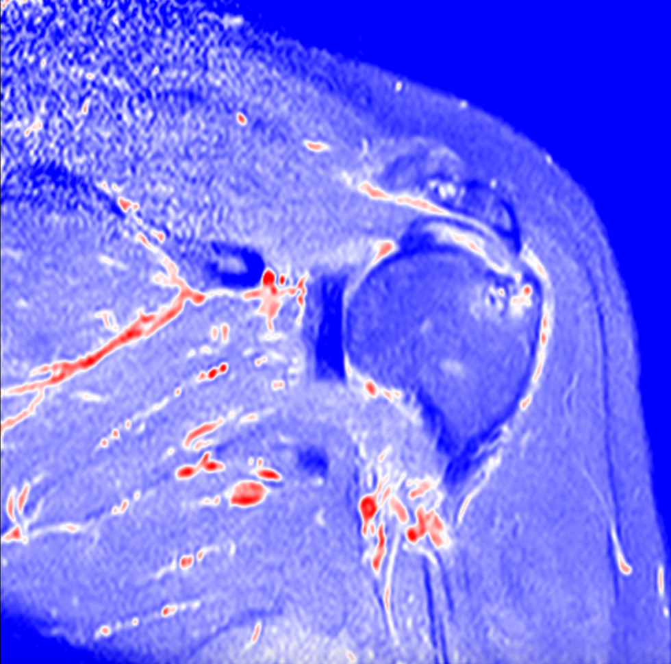 MRI Rotator Cuff injury with Labrum Tear | NR RADIOLOGY